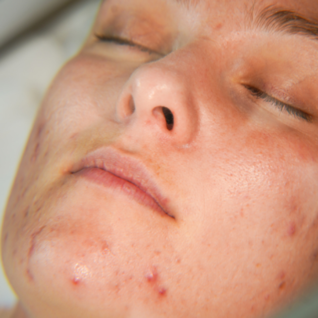 Meer pukkels in de herfst | De Huidkliniek