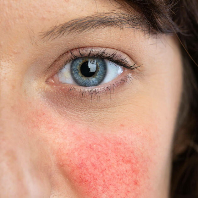 Couperose behandeling | De Huidkliniek