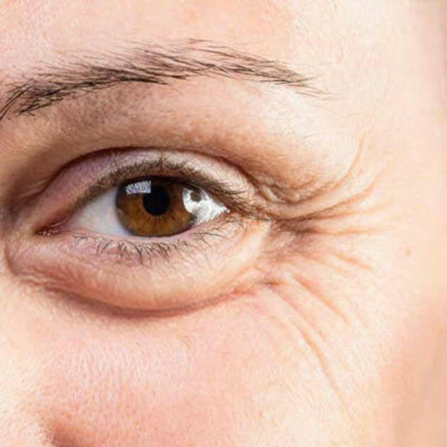 Rimpels | De Huidkliniek